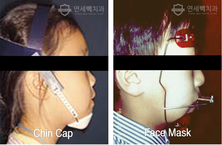 연세백치과 칼럼 - 주걱턱 교정치료는 어떻게 하나요?